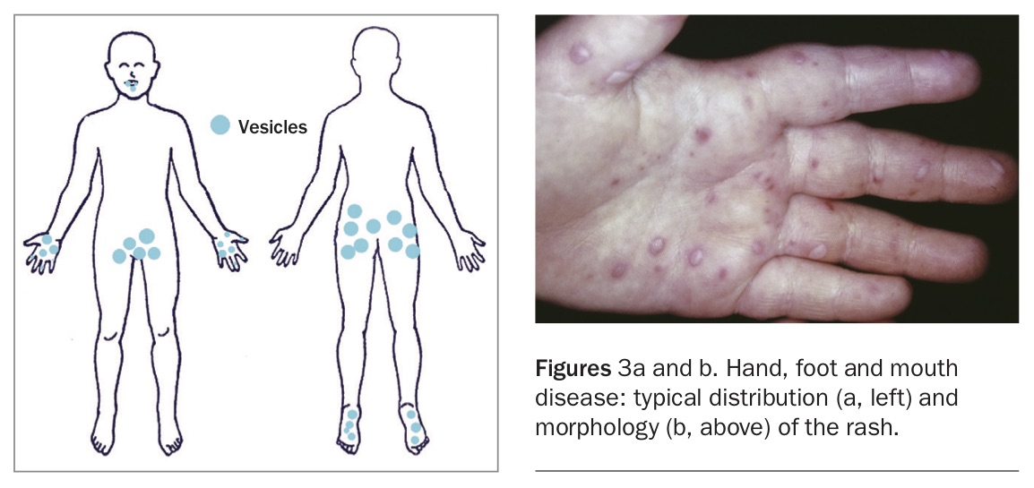Unilateral Laterothoracic Exanthem Treatment